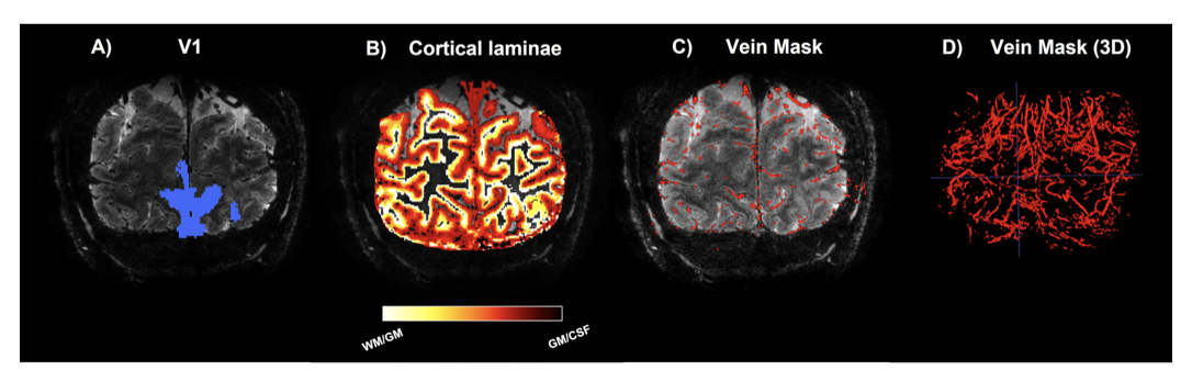 The contribution of the vascular architecture and cerebrovascular ...
