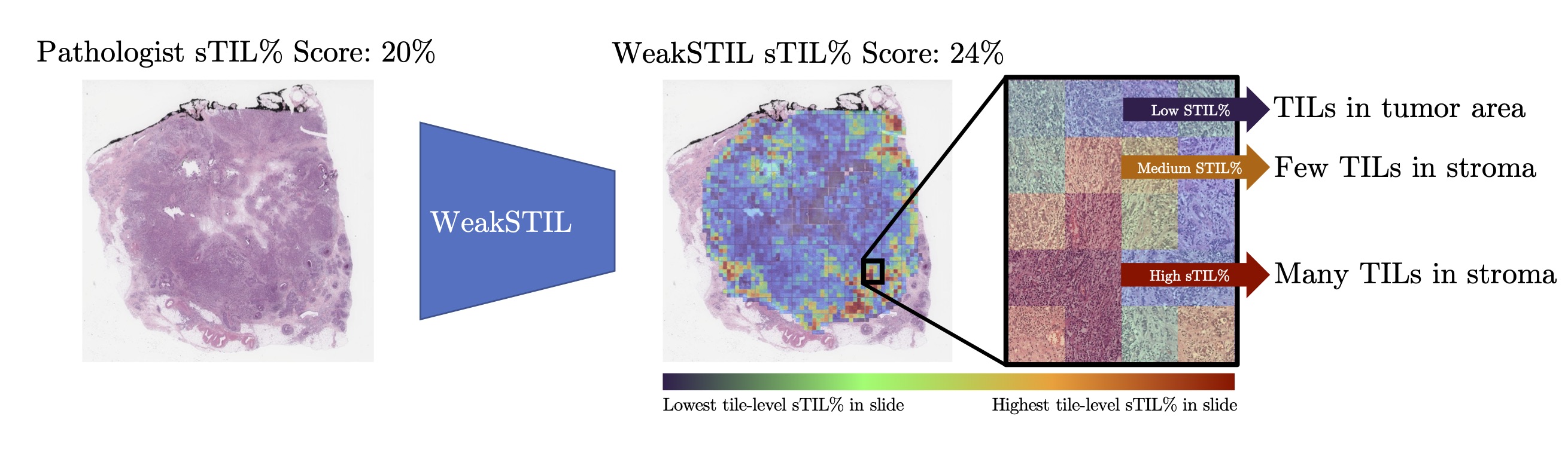 WeakSTIL: weak whole-slide image level stromal tumor infiltrating lymphocyte scores are all you ...